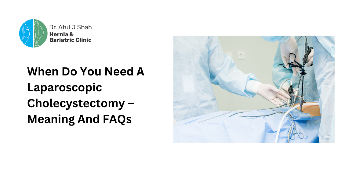 When Is Laparoscopic Cholecystectomy Needed? Meaning & FAQs